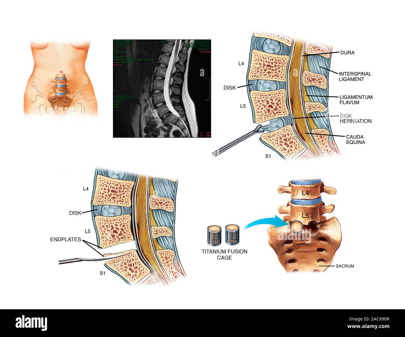 Surgery to fuse the lumbar spine. Sequence of artworks of an operation ...