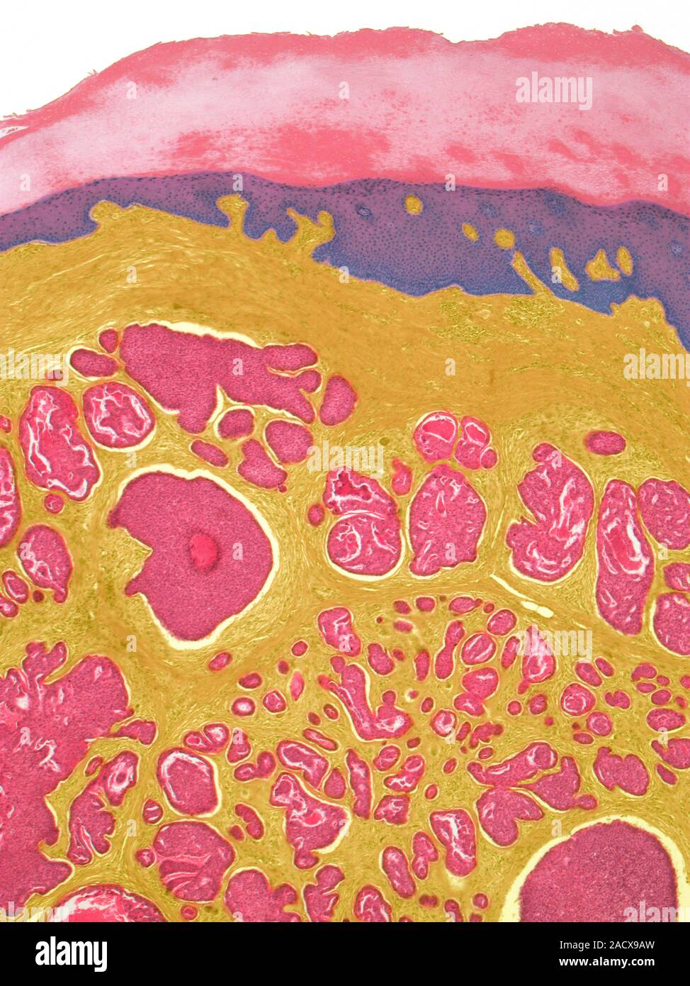 Digital papillary adenoma, light micrograph of a section of affected ...
