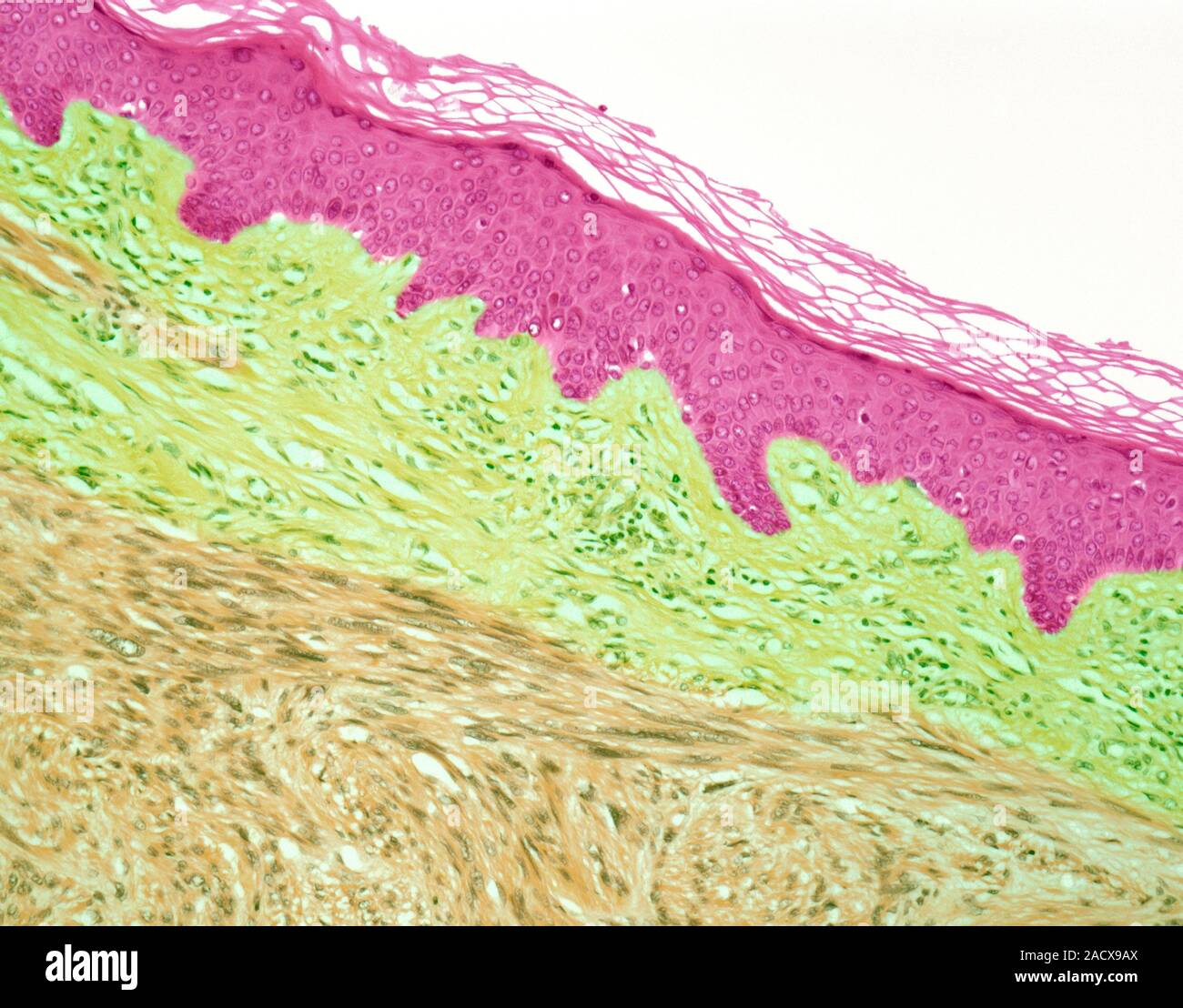 Skin cancer, light micrograph of a section of affected skin ...
