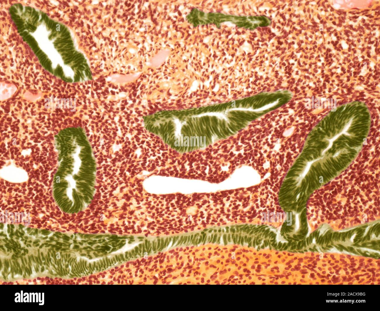 Endometrial stromal sarcoma, light micrograph of a section of uterus ...