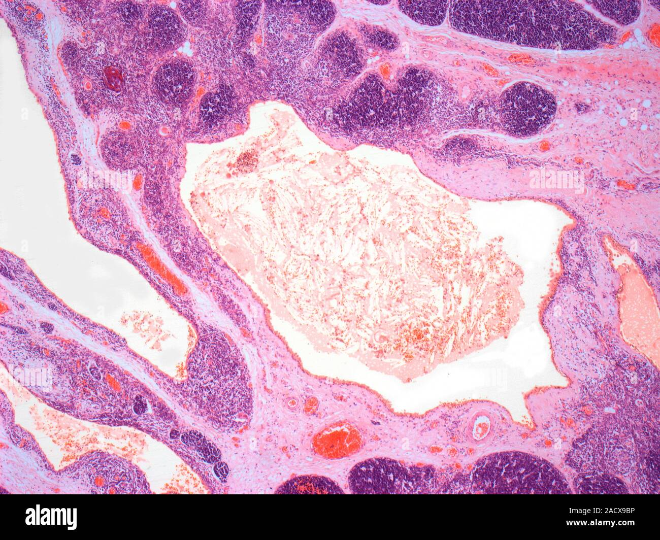 Multilocular thymic cysts, light micrograph of section of thymus ...