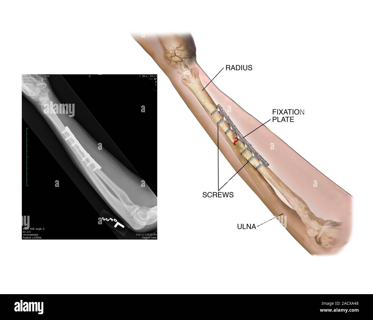 Internal fixation of fractured radius. Labelled artwork and ...