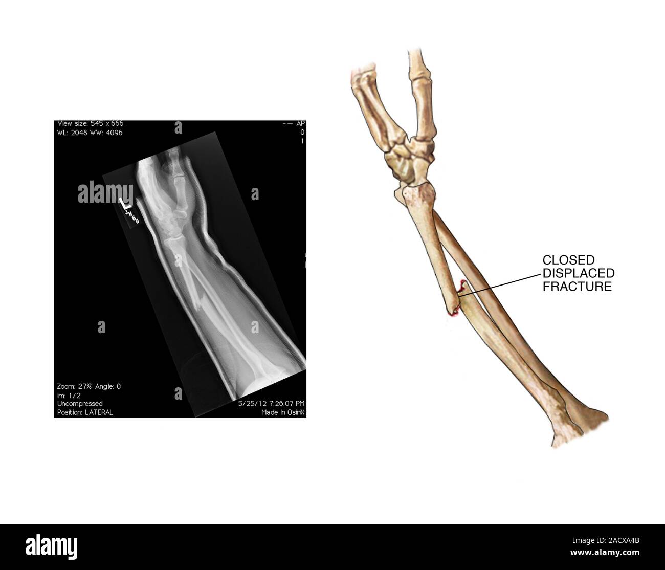 Displaced fracture of the radius. Labelled artwork and corresponding X ...