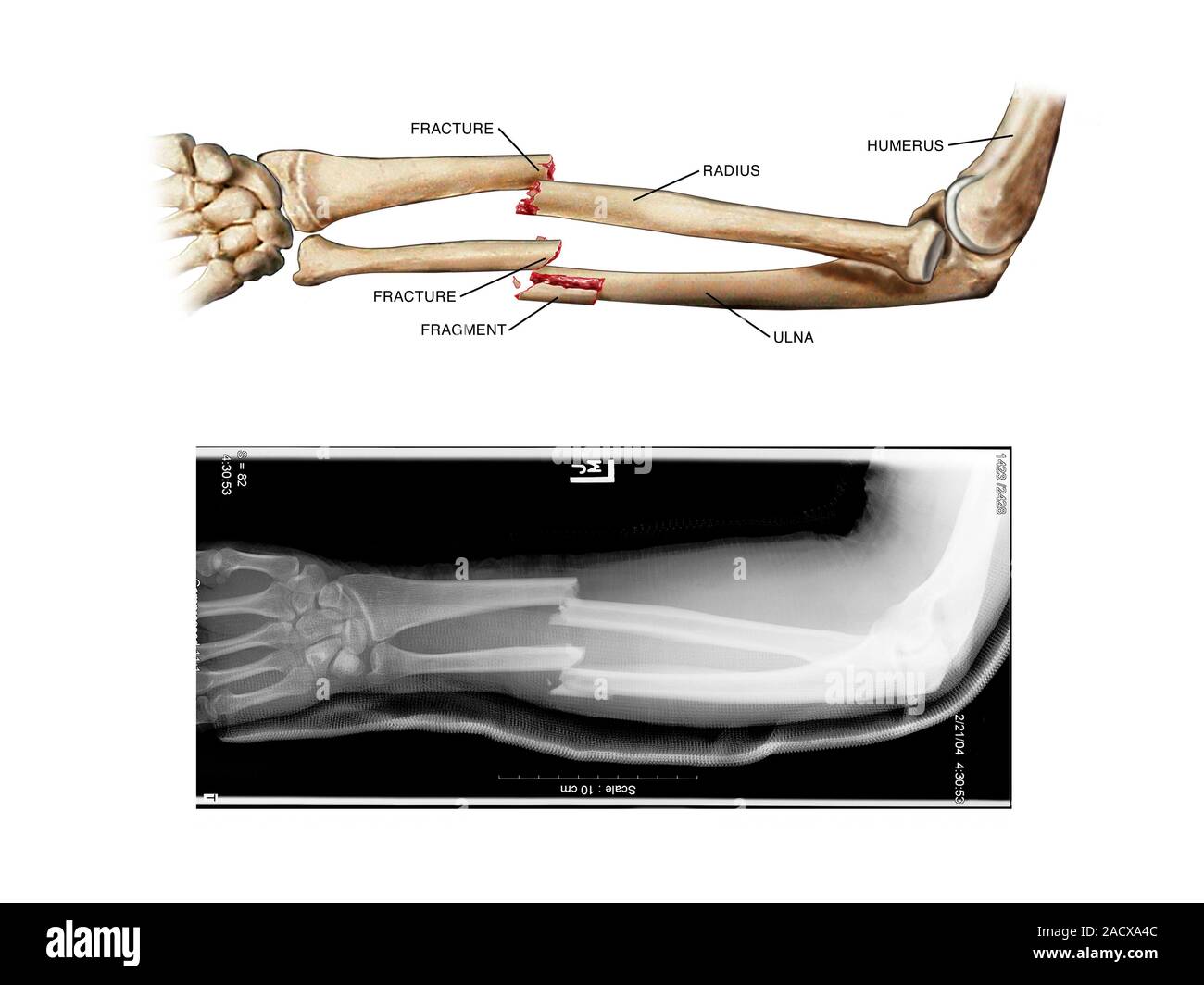 Comminuted fractures of arm bones. Labelled artwork and corresponding X ...