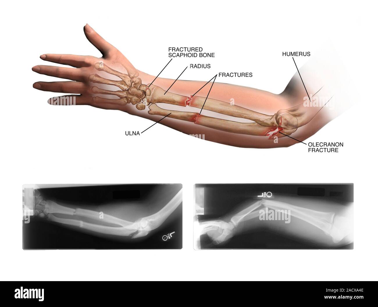 Ulna Bone Wrist Wrist Joint Replacement (Arthroplasty) Orthopedic