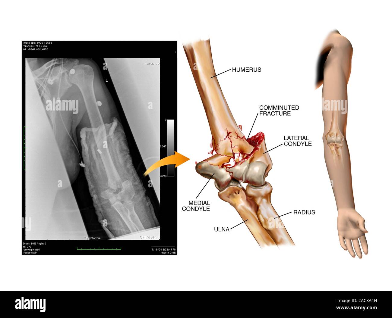 Comminuted fracture of the elbow. Labelled artwork and corresponding X ... Comminuted fracture of the elbow. Labelled artwork and corresponding X ...