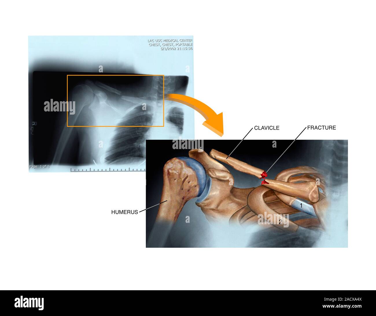 Fractured collar bone. Labelled artwork and corresponding X-ray of a ...