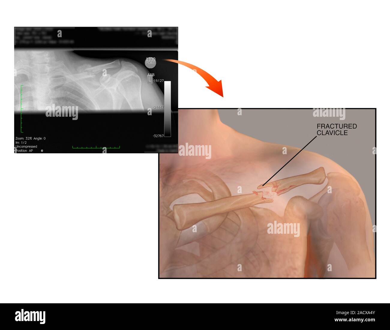 Fractured collar bone. Labelled artwork and corresponding X-ray of a ...
