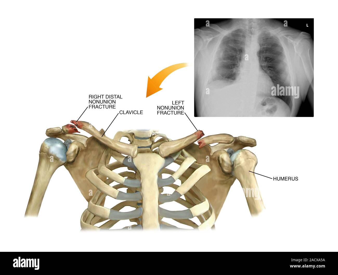 Bilateral collar bone fractures. Labelled artwork and corresponding X ...