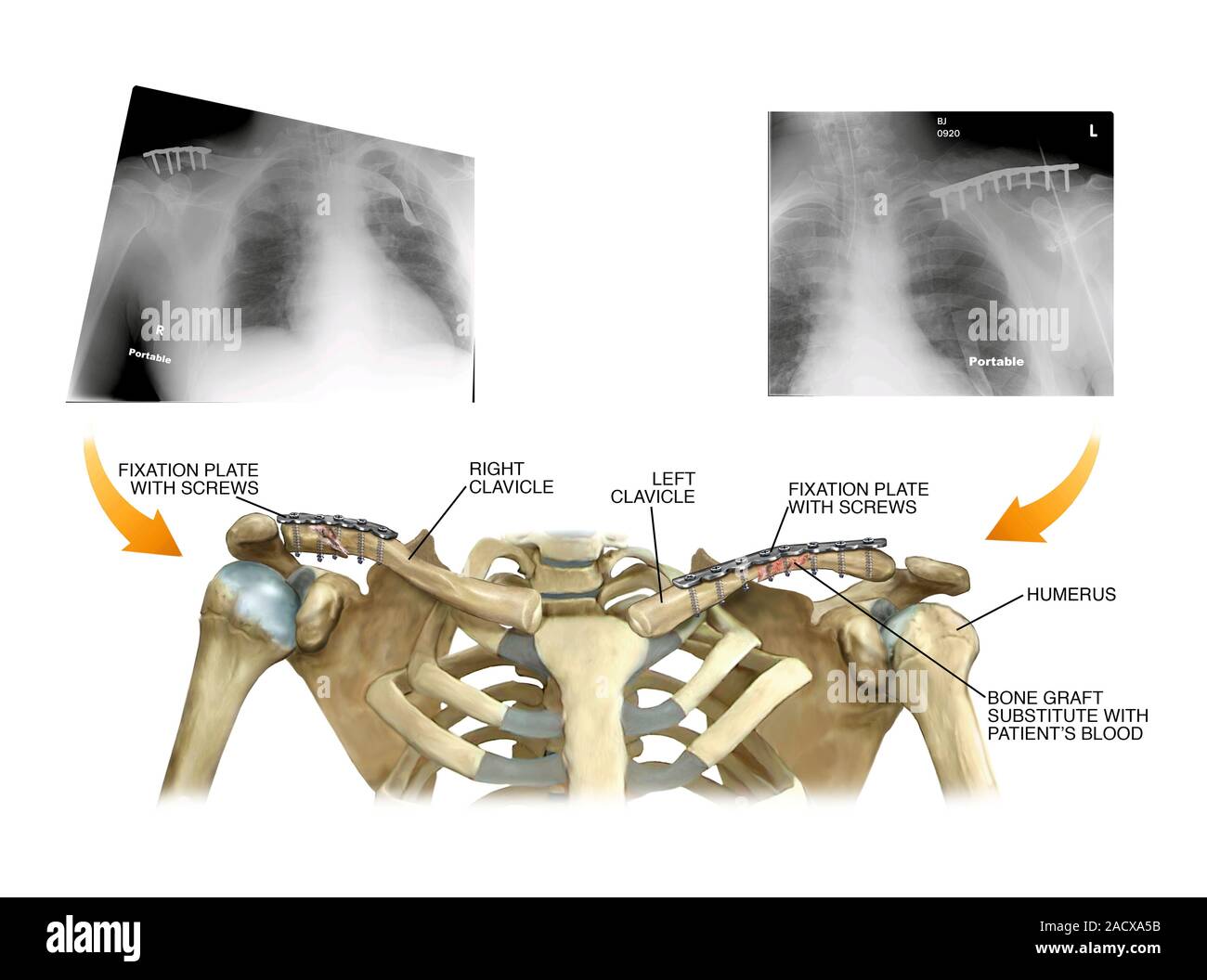 Internal fixation of broken collar bones. Labelled artwork and ...