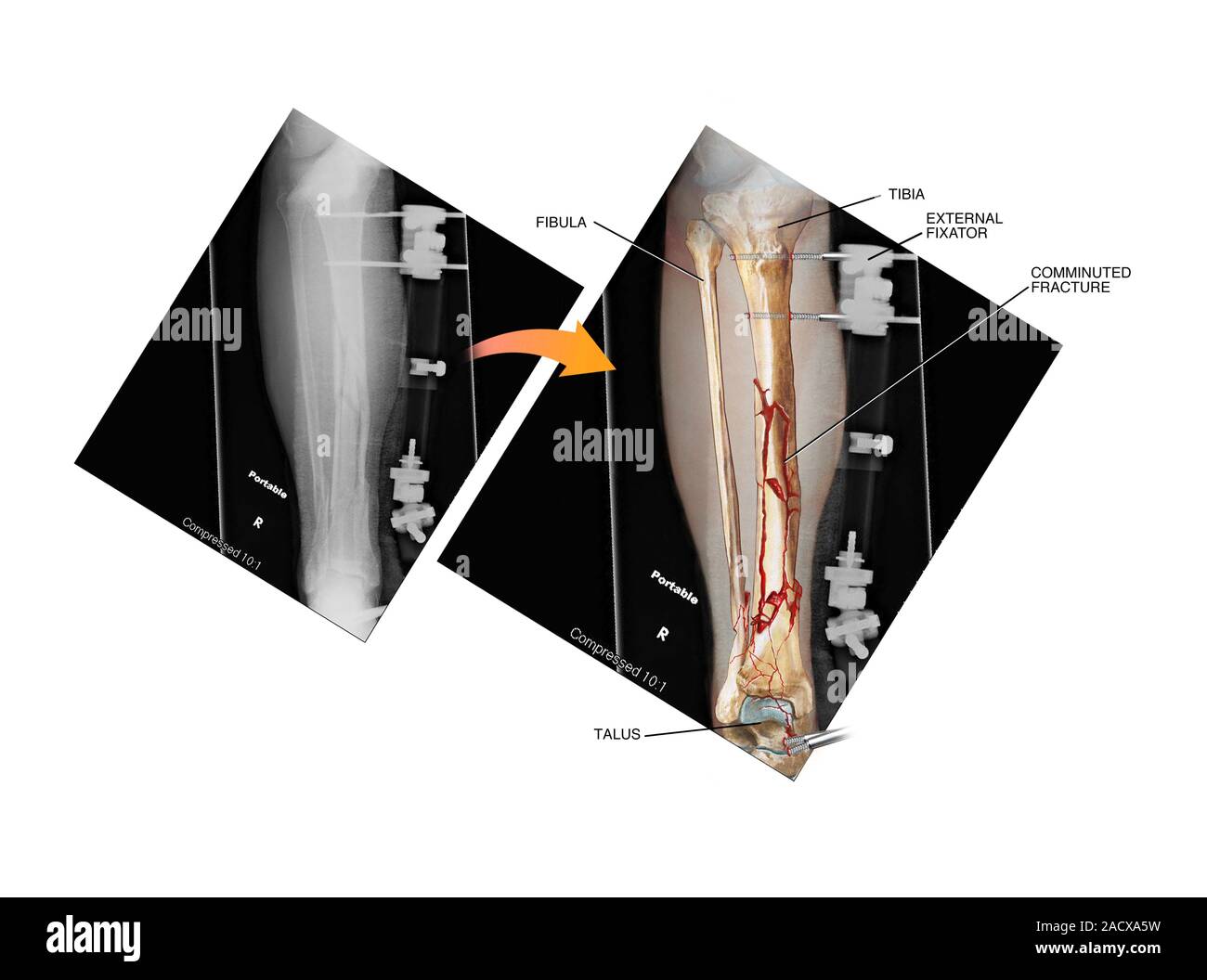 External fixation of fractured tibia. Labelled artwork combined with X ...