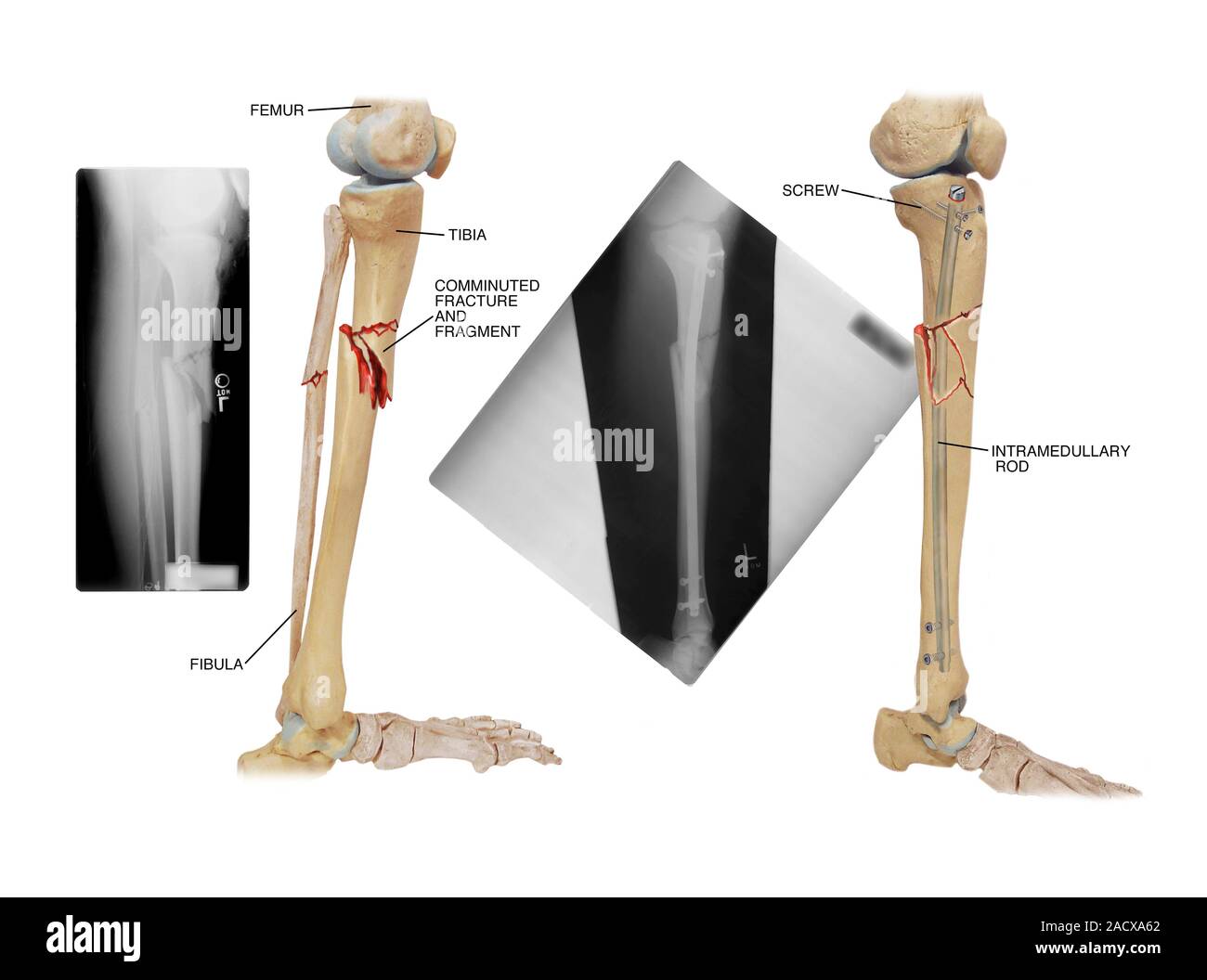 Internal fixation of lower leg bones. Labelled artworks and ...