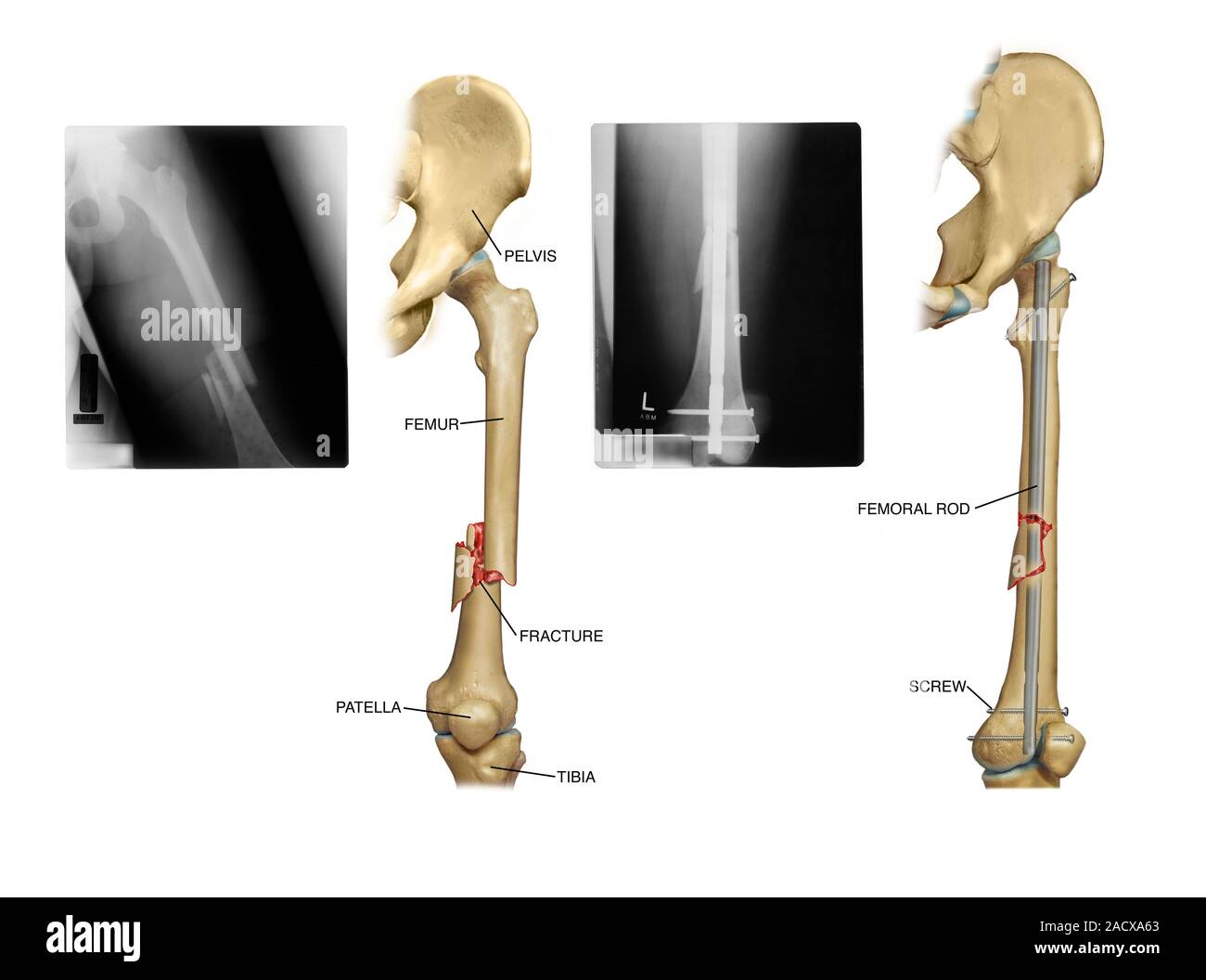Internal fixation of fractured femur. Labelled artworks and ...