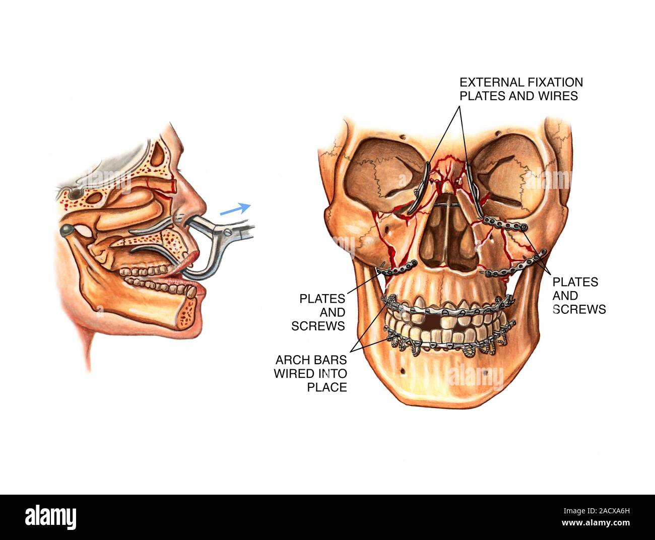Facial fractures reduction and fixation. Labelled artwork of the ...