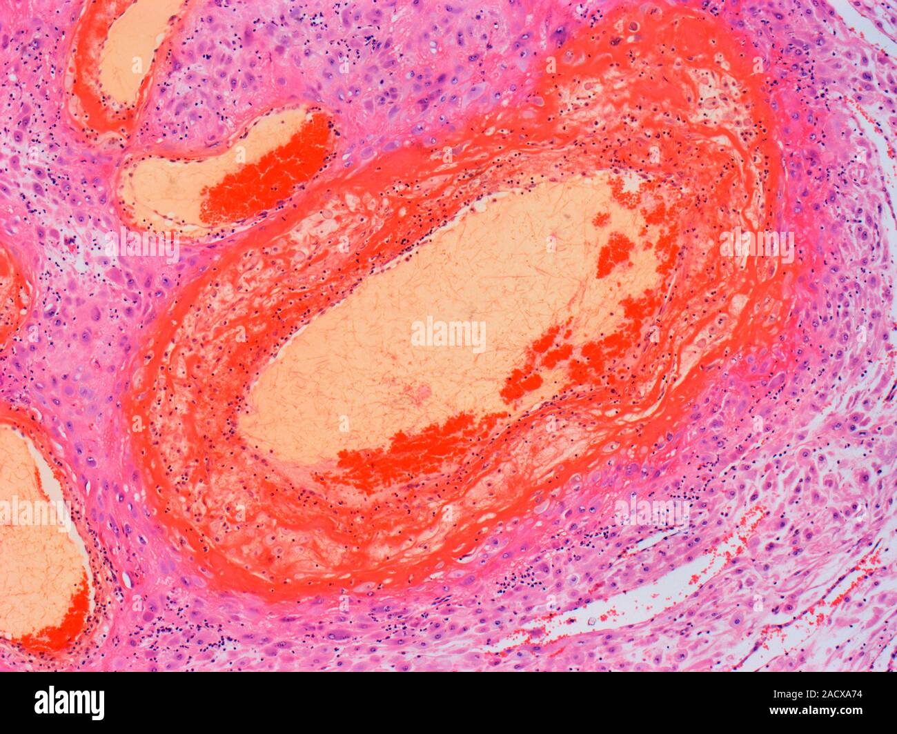 Placental atherosis, light micrograph of a section of a placenta from ...