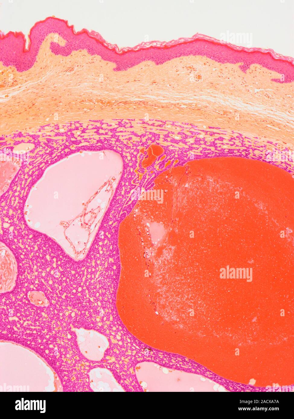 Skin cancer, light micrograph of a sectionof a dermal cylindroma of the ...