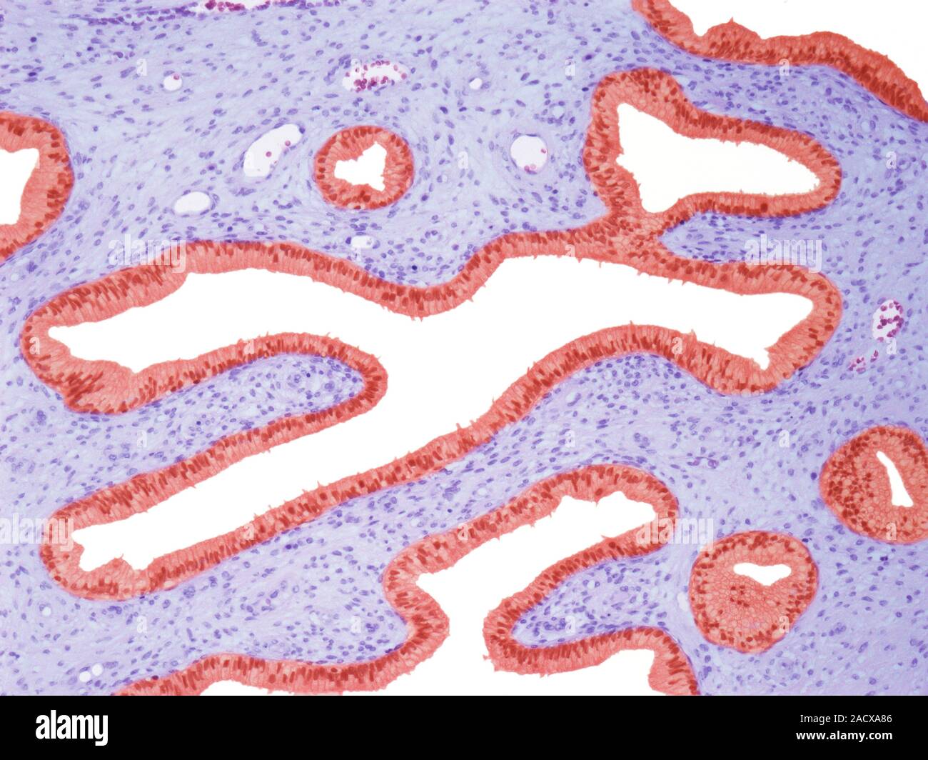 Endometriosis, light micrograph of section of affected tissue ...