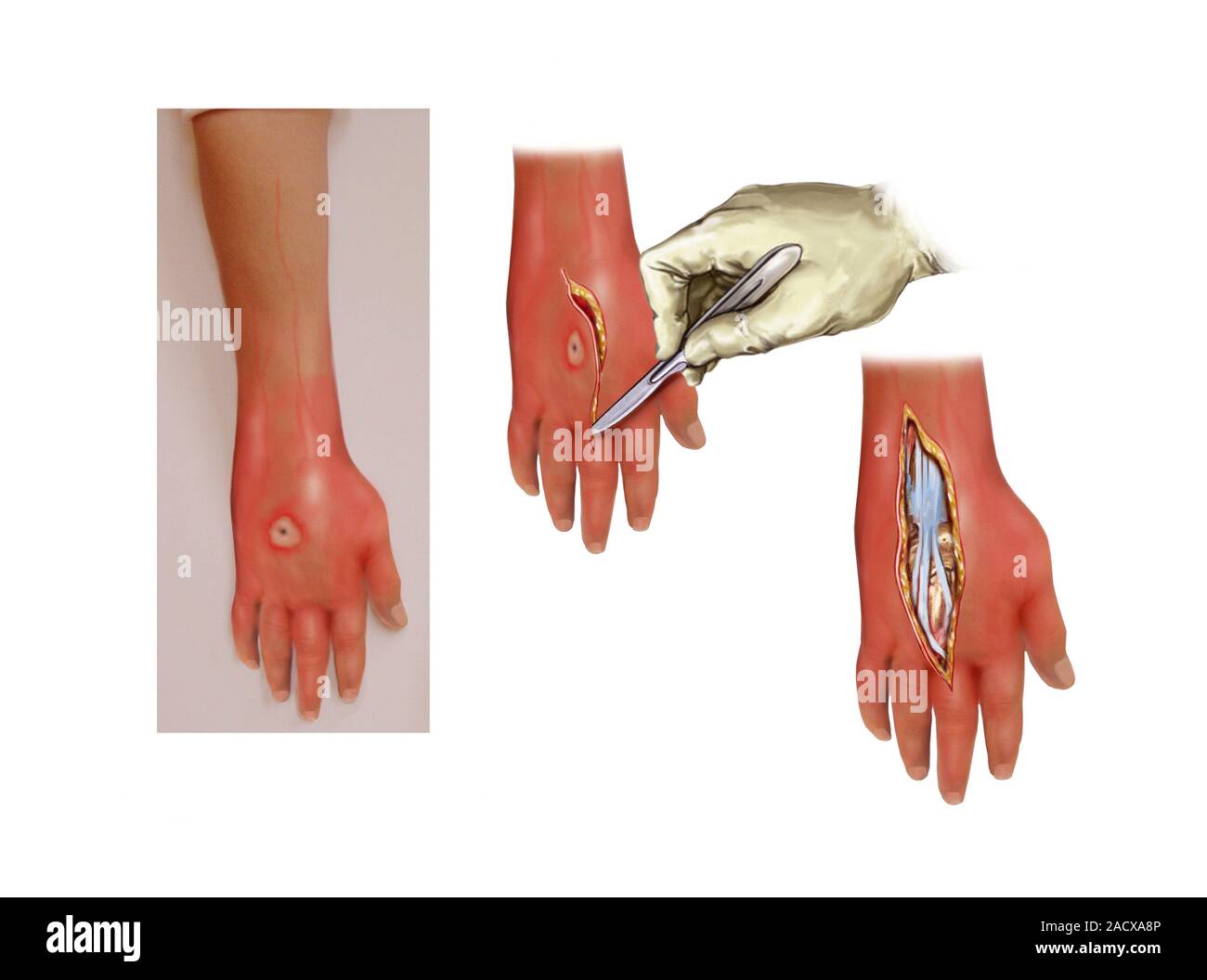 Woundcare for infected hand. Sequence of artworks showing wound ...