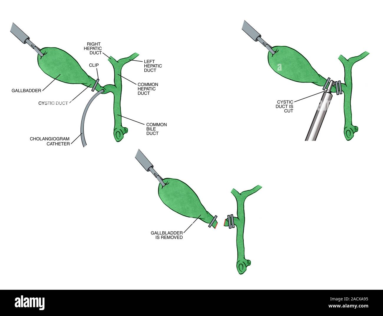 Laparoscopic gallbladder removal surgery. Artwork sequence illustrating ...