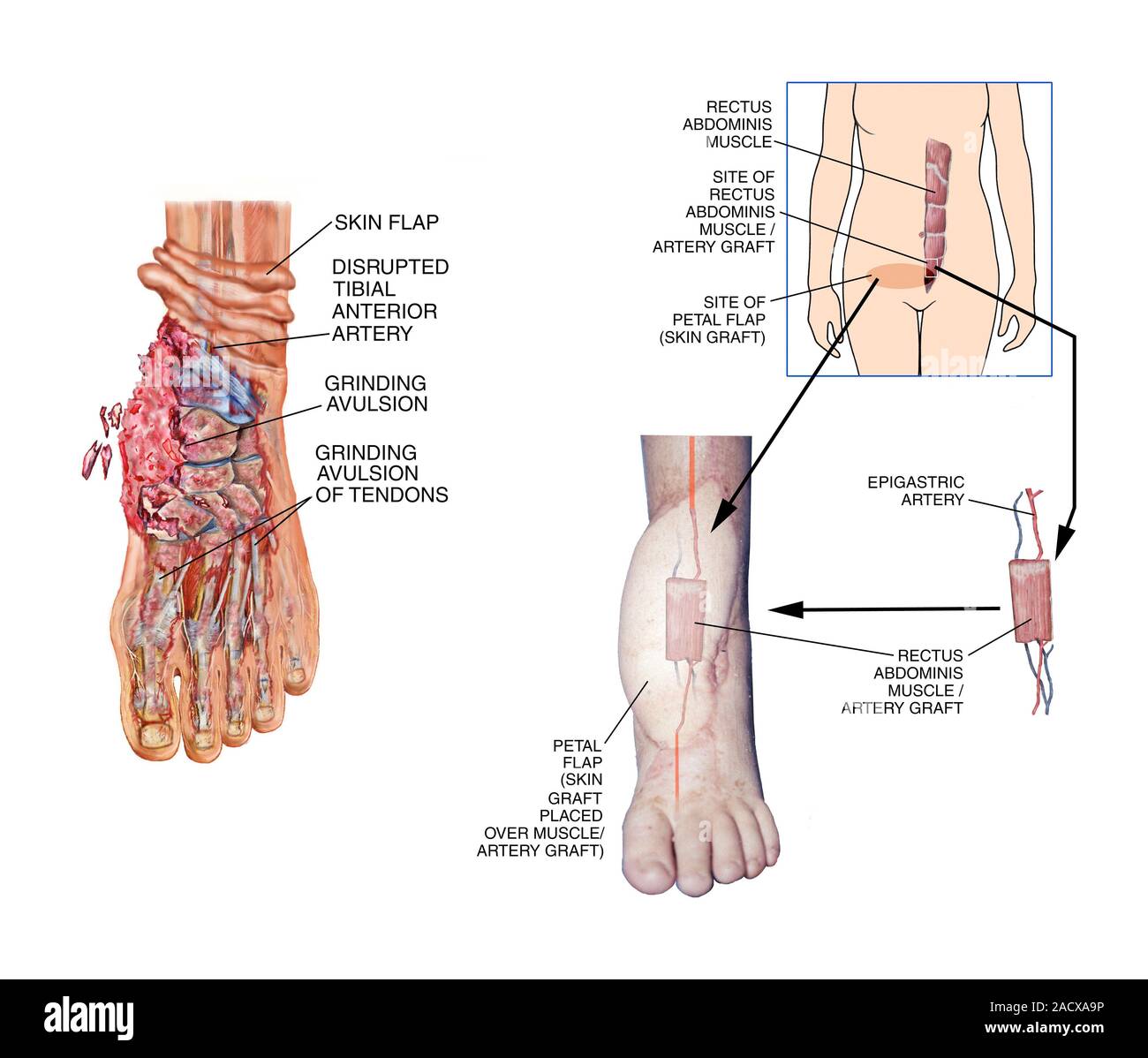 Graft surgery for degloving foot injury. Artworks illustrating the muscle and skin graft ...