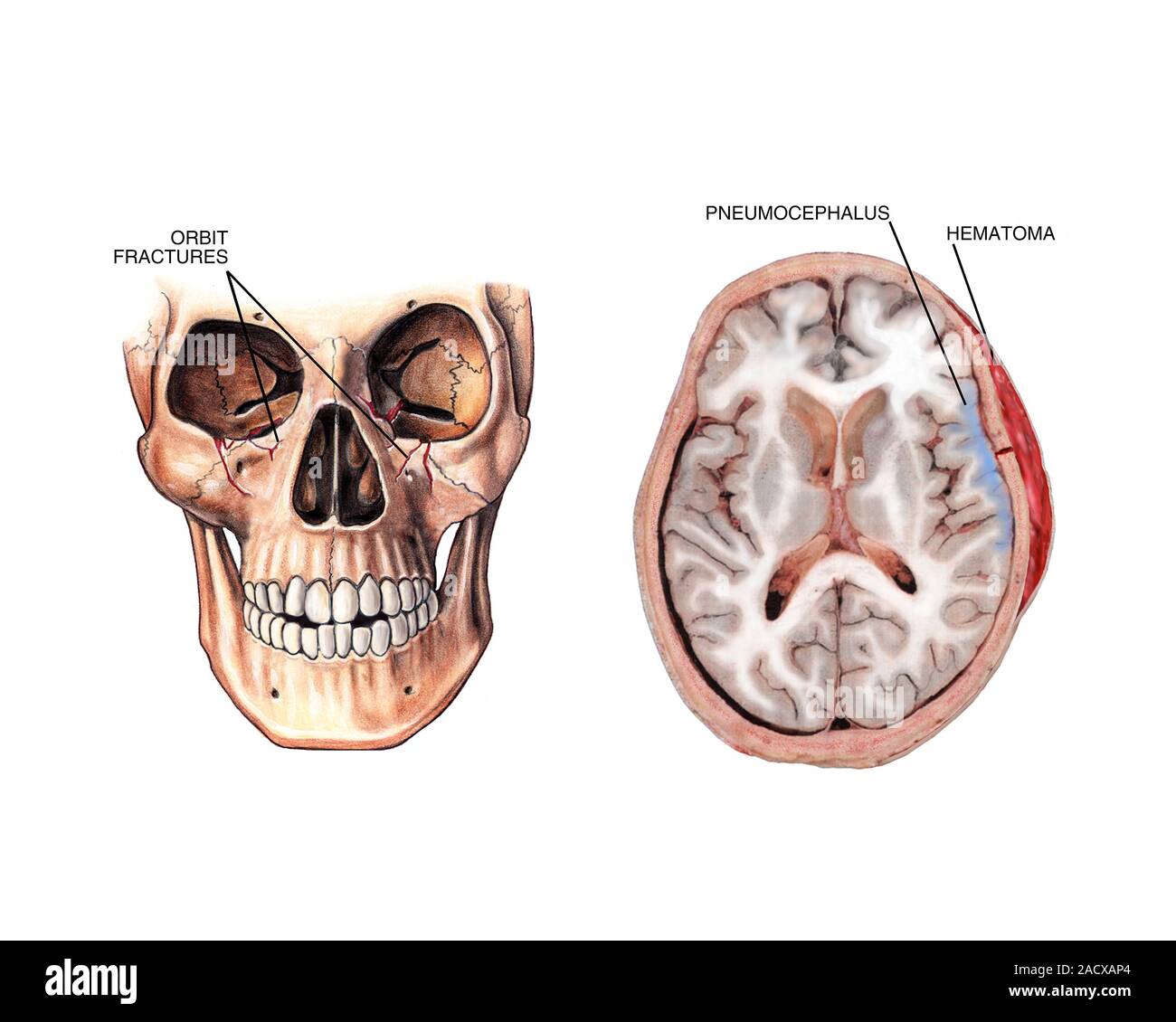 Facial fractures and brain injuries. Labelled artworks of fractures to ...