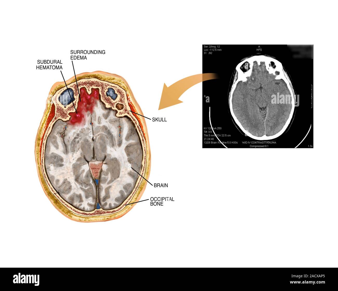 Subdural haematoma. Labelled artwork and corresponding computed ...