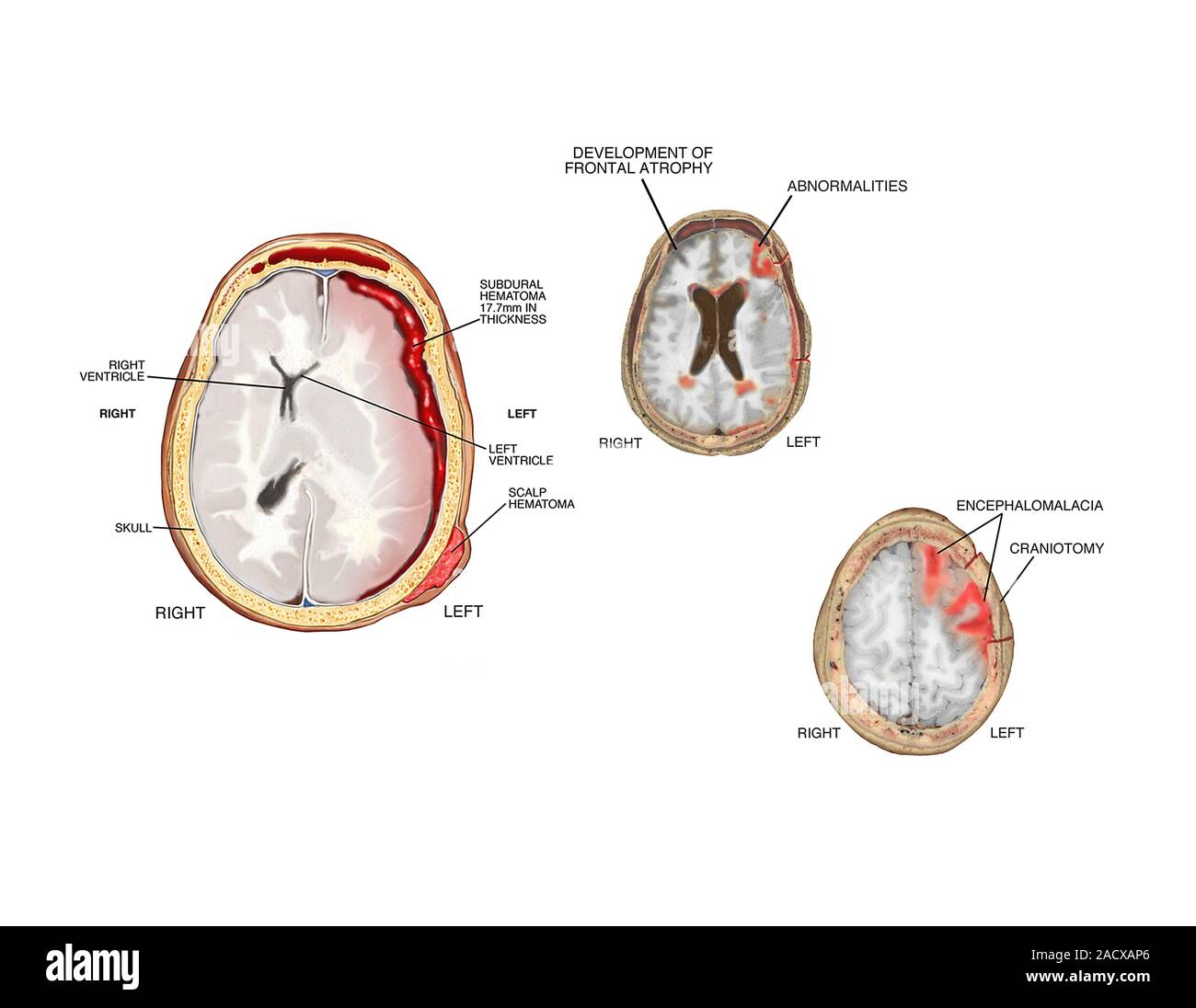 Brain injuries and abnormalities. Labelled artworks of axial views of ...