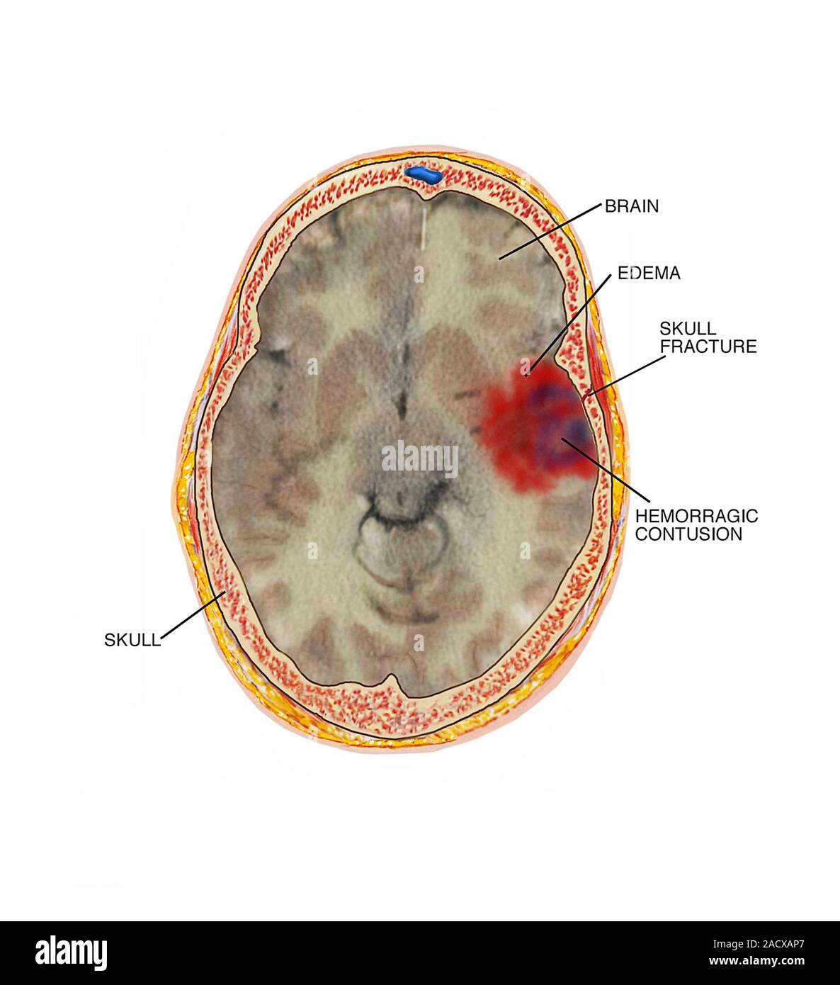 Brain Internal Bleeding