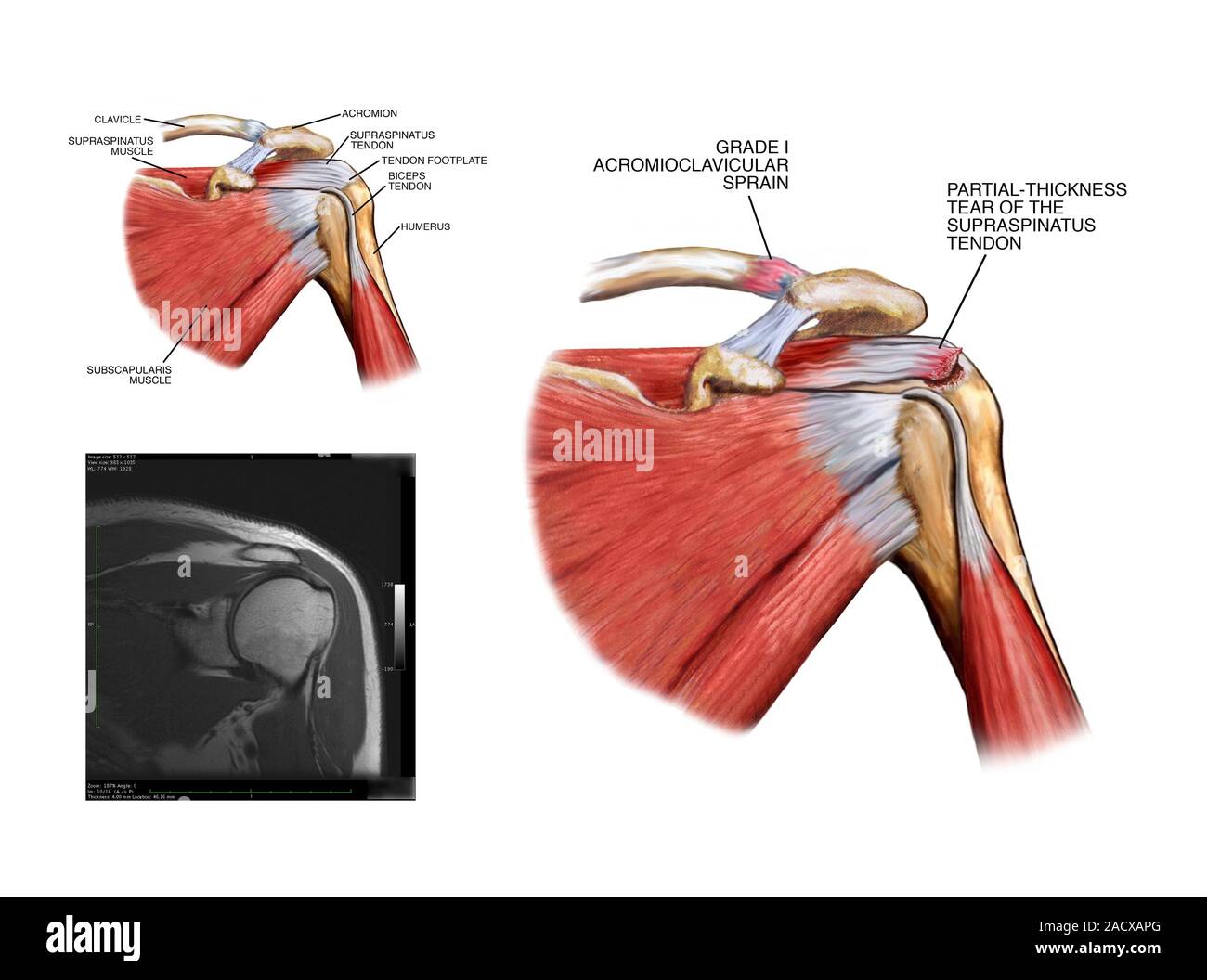 Shoulder tendon injury. Labelled artworks and corresponding magnetic ...