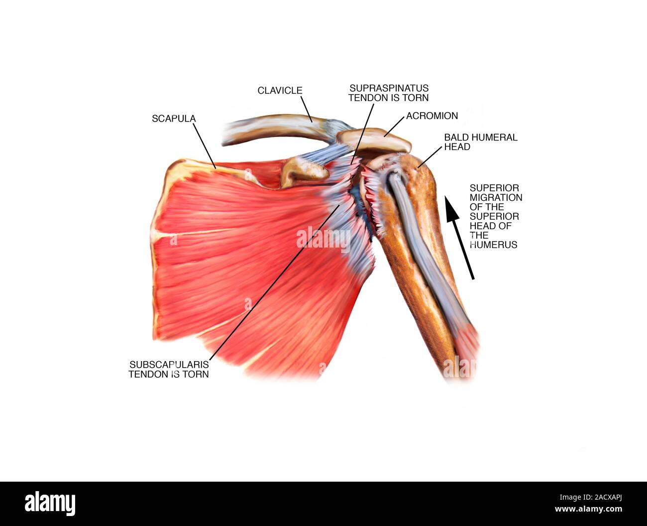 Shoulder tendon injury. Labelled artwork of an anterior (frontal) view ...
