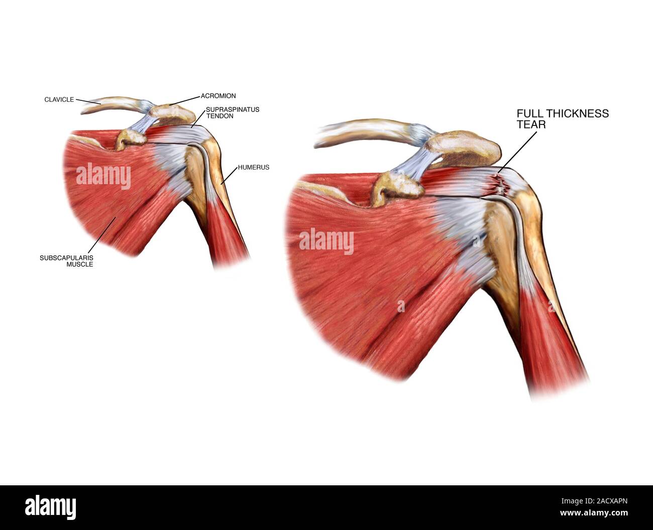 Shoulder tendon injury. Labelled artwork (right) of an anterior ...