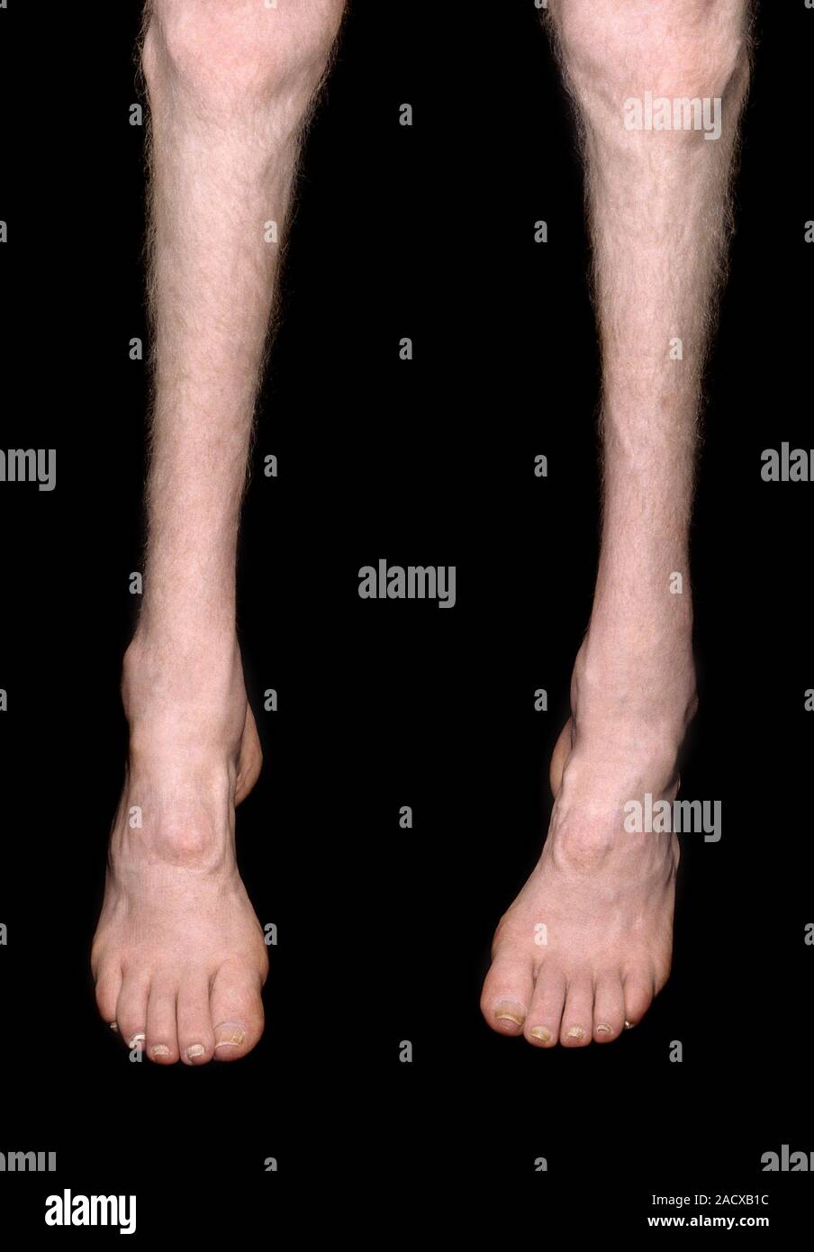 Charcot-Marie-Tooth disease. Arched feet (pes cavus) with muscle ...