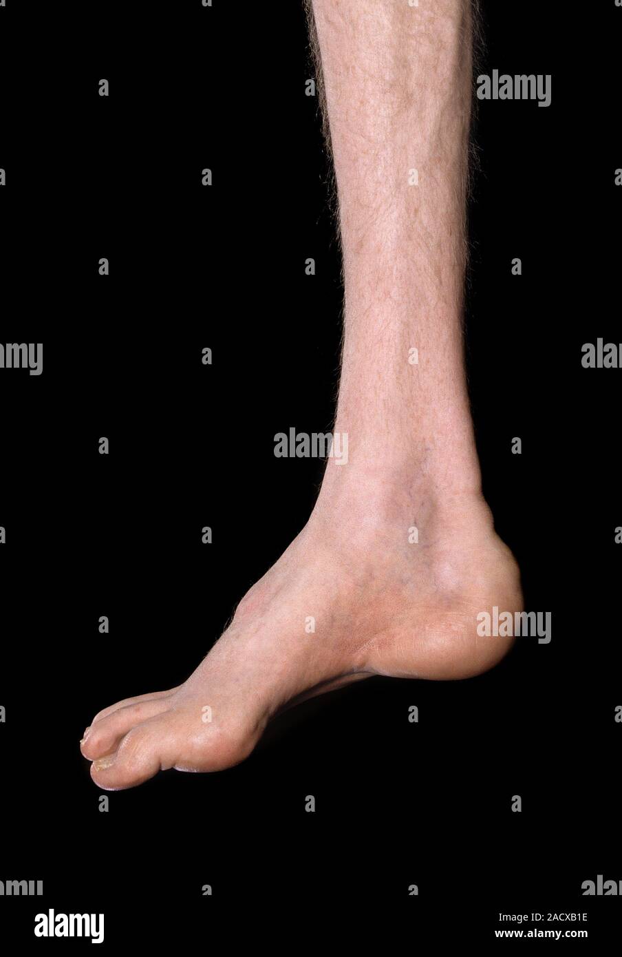 Charcot-Marie-Tooth disease. Arched foot (pes cavus) with muscle ...