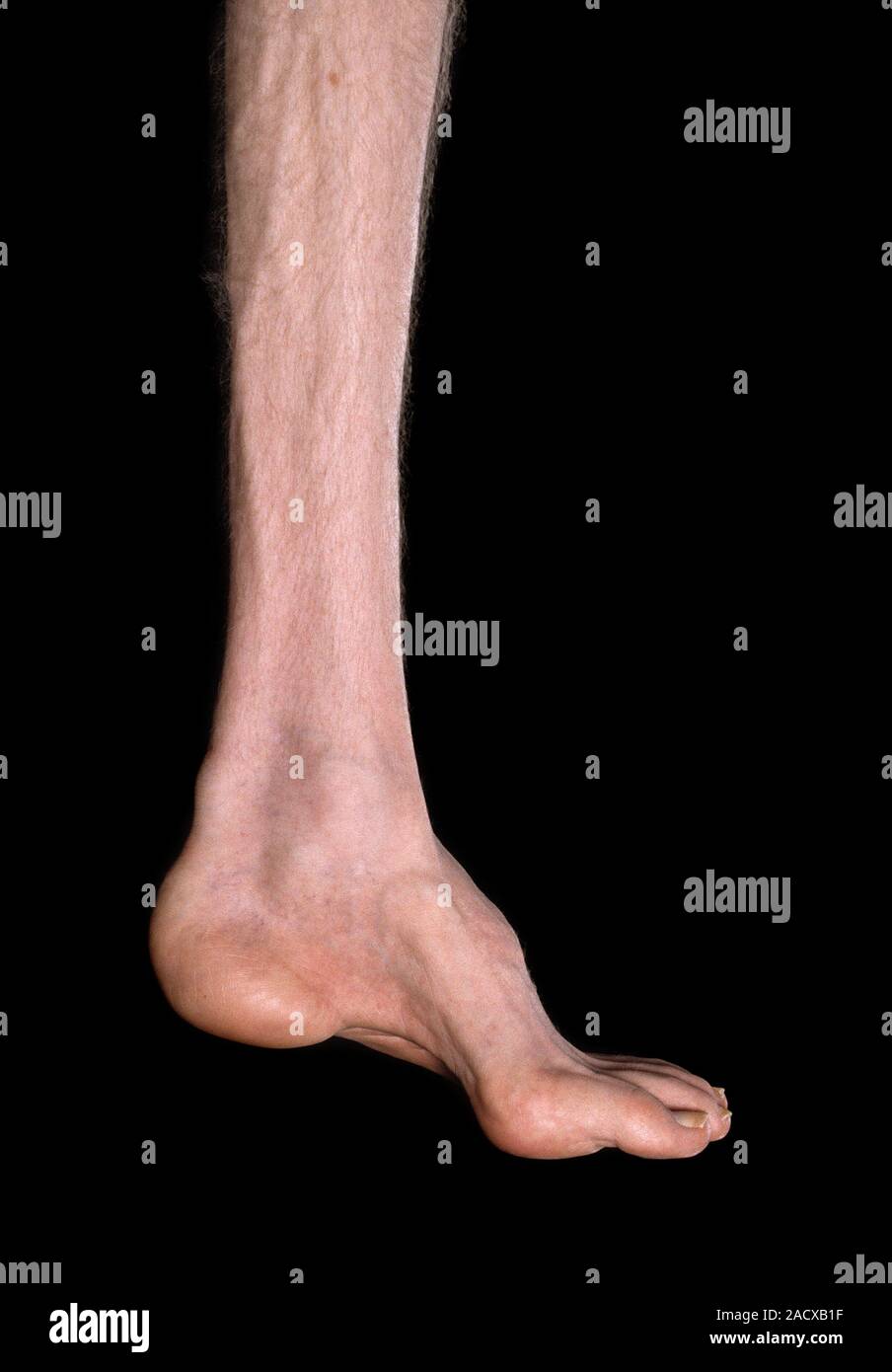 Charcot-Marie-Tooth disease. Arched foot (pes cavus) with muscle ...
