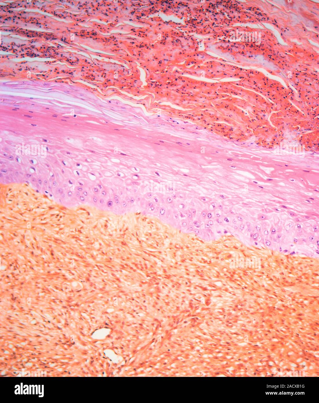 Atypical fibroxanthoma, light micrograph section from a skin tumour ...