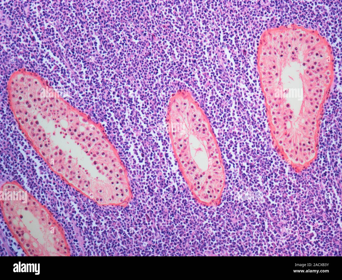 Testicular cancer, light micrograph of a section from a testicular ...