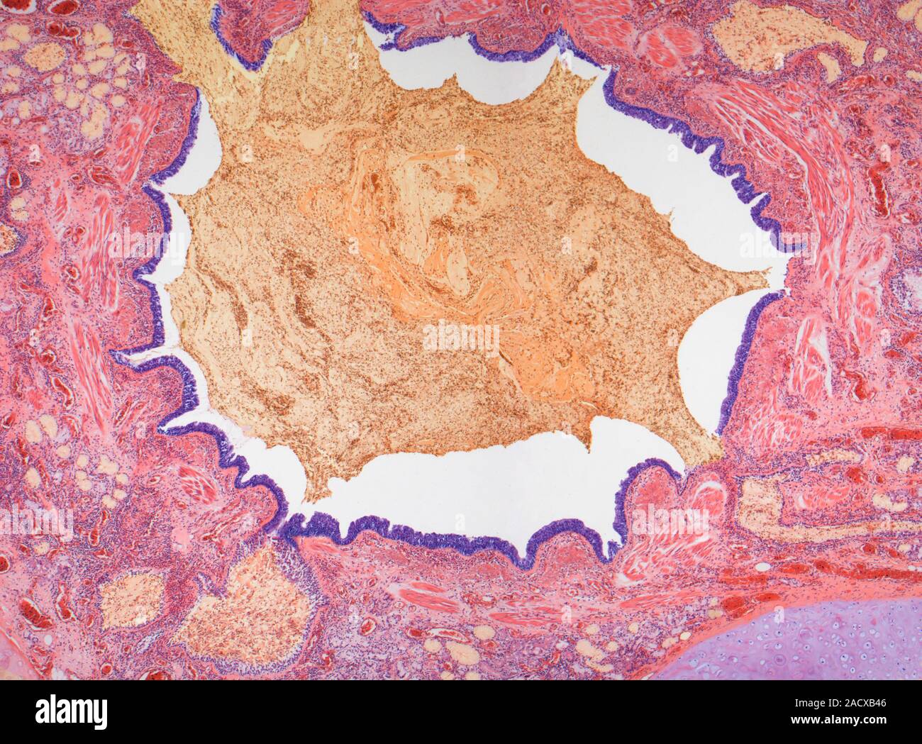 Bronchiole asthma, light micrograph of a section of affected airway ...