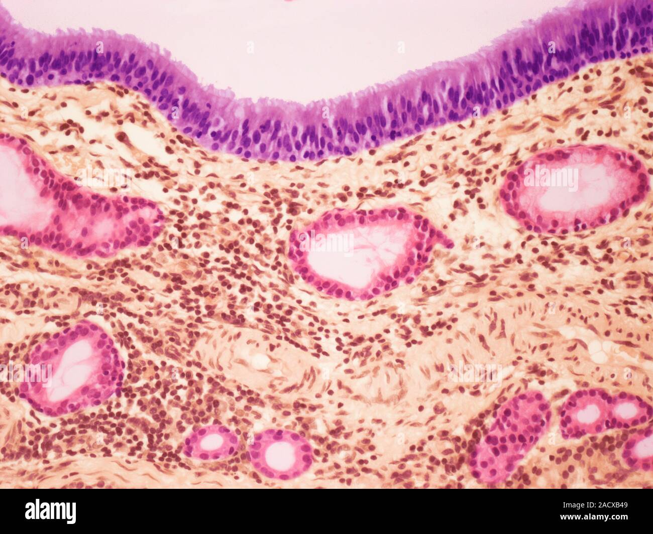 Sinusitis, light micrograph of a section of affected nasal tissue ...