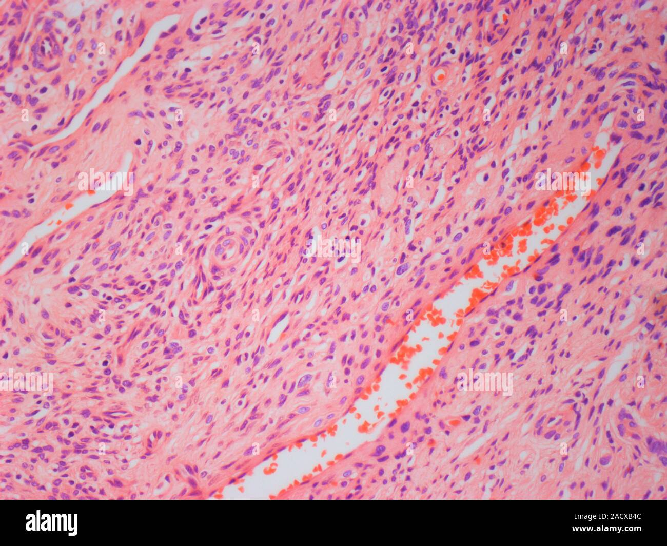 Infantile myofibroma, light micrograph of a section of tumour ...