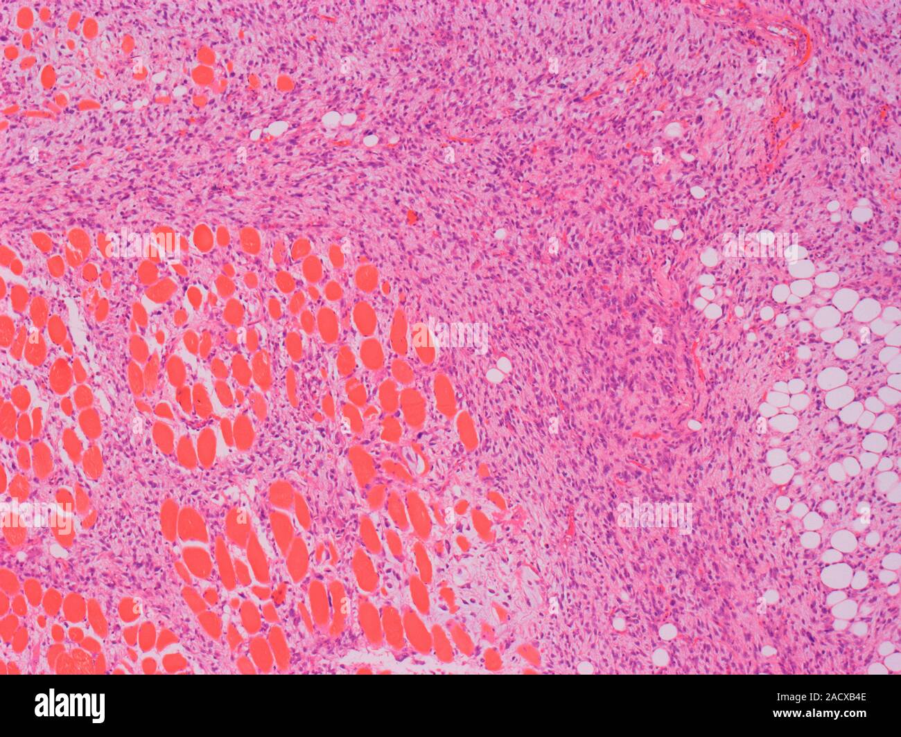 Polymyositis, light micrograph of a section of affected muscle ...