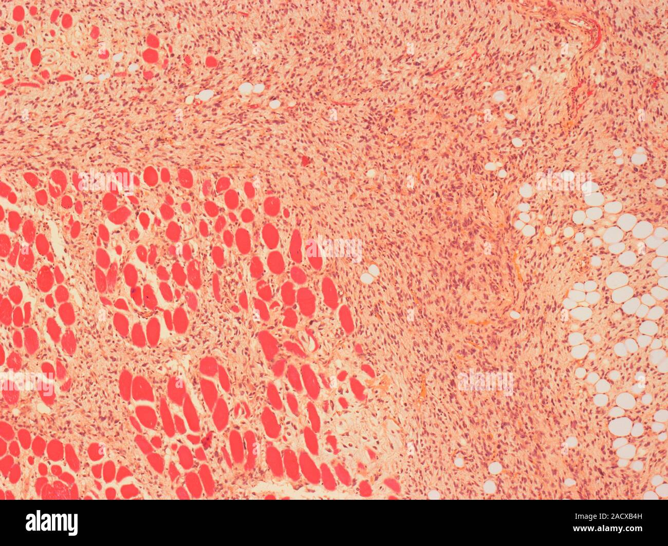 Polymyositis, light micrograph of a section of affected muscle ...