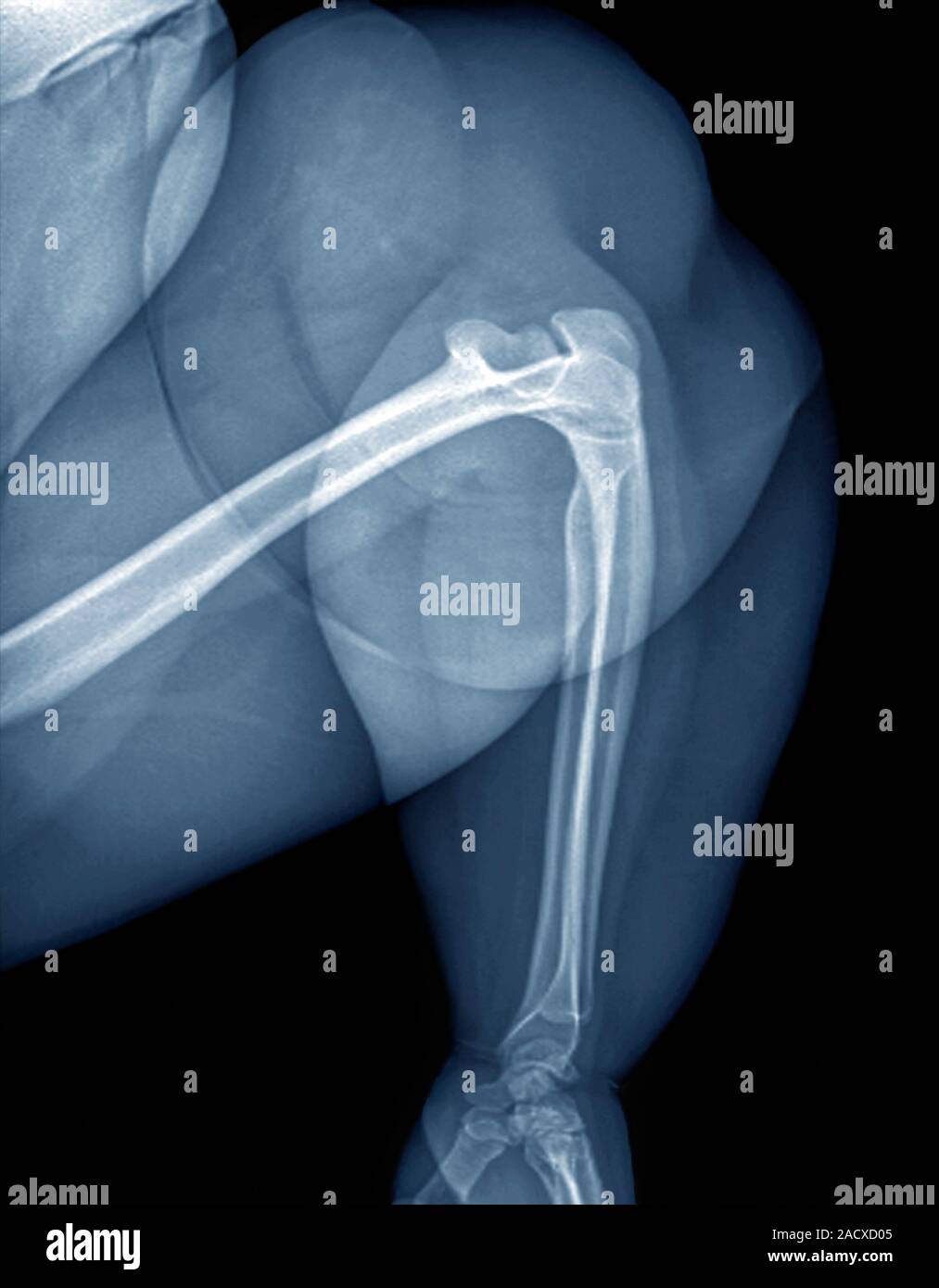Coloured x-ray of the left arm (anterior view) of an obese 23 year-old ...