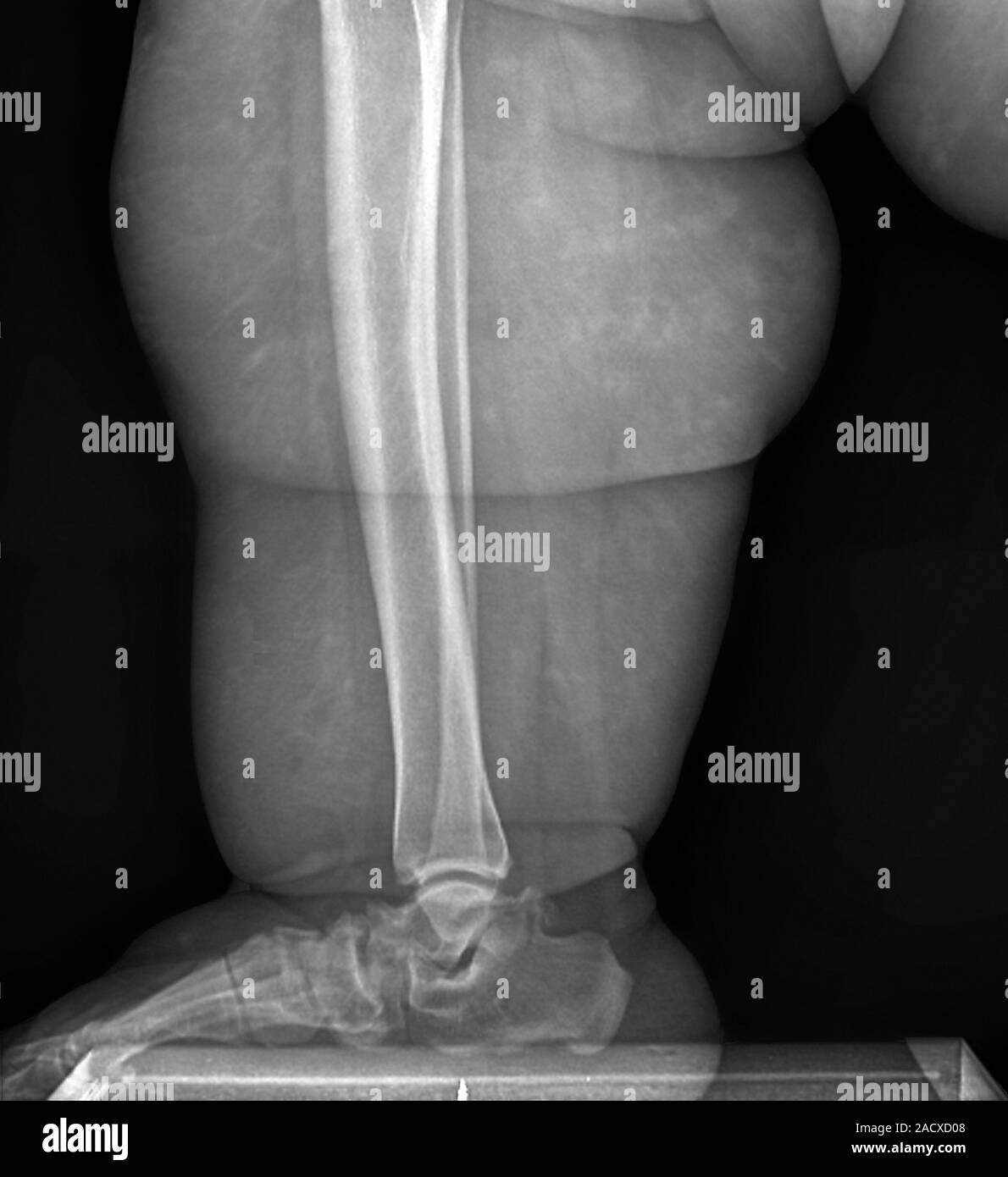 X-ray of the right lower leg and foot (side view) of an obese 23 year ...