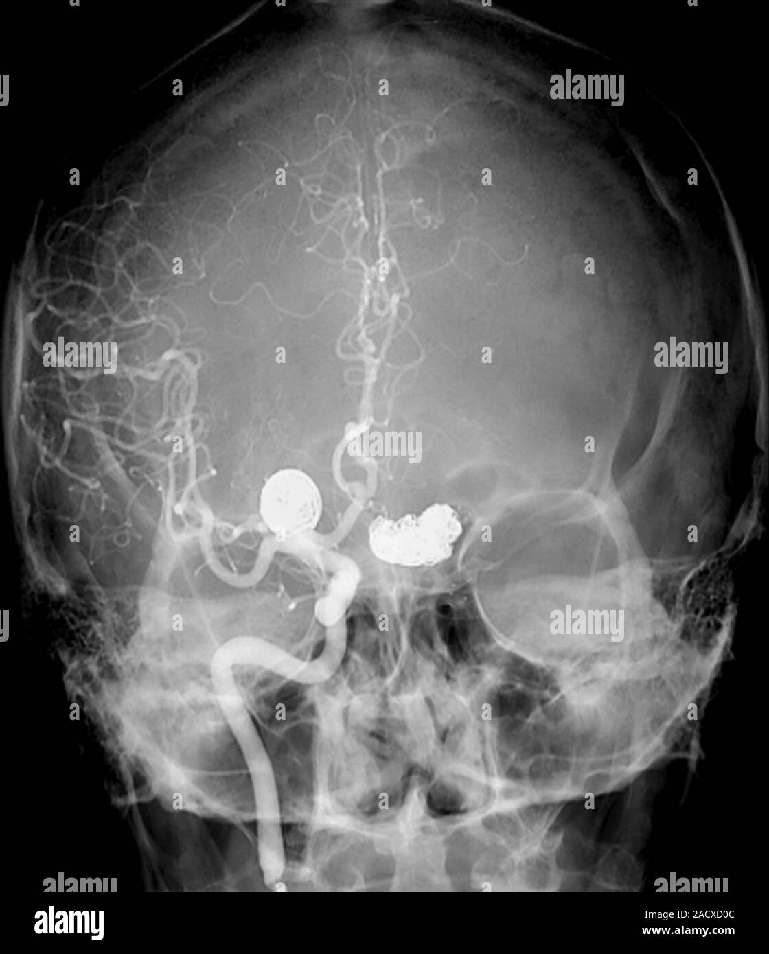 Angiogram (blood vessel X-ray, frontal view) of the head of a 51 year ...