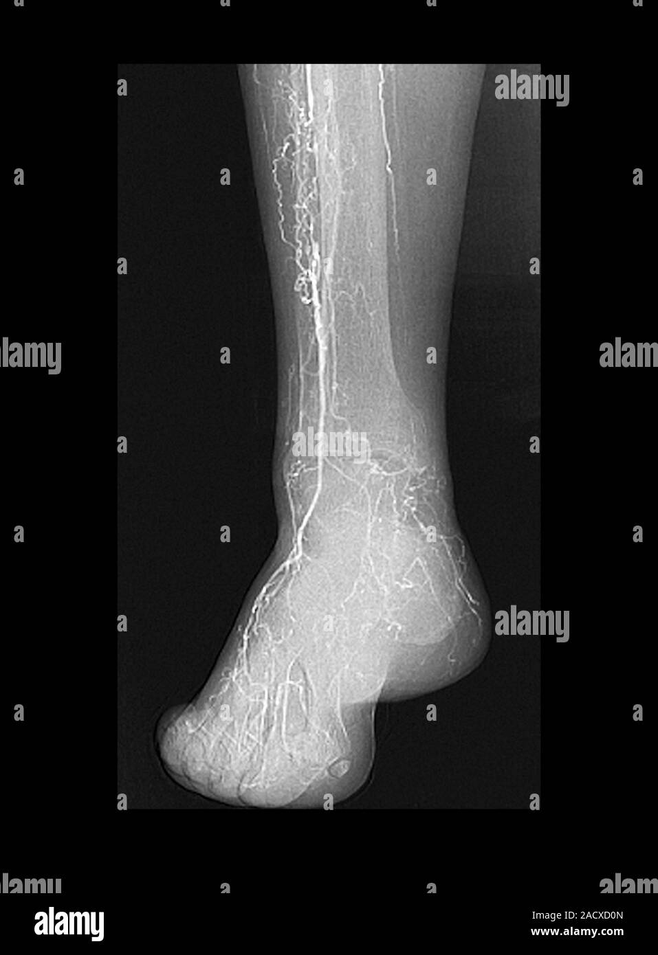Angiogram (blood vessel X-ray) of a 72 year-old woman's right leg ...