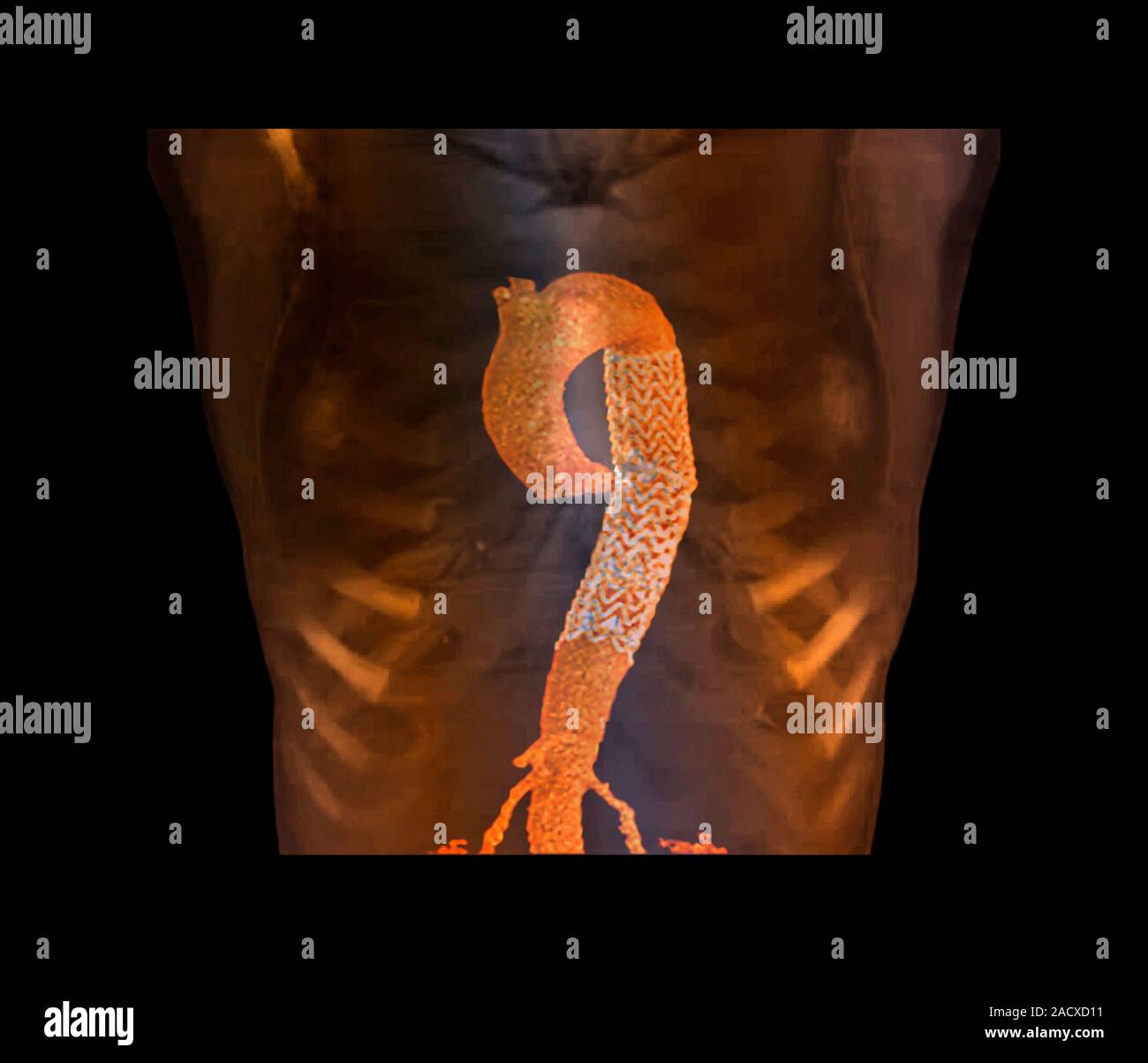 Aortic stent. Coloured three-dimensional computed tomography (3D CT ...