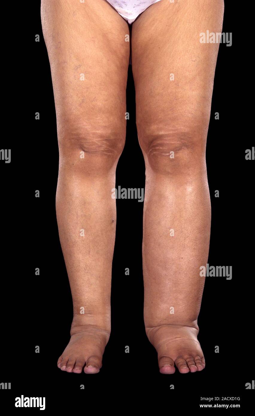 Lymphoedema Swollen Left Leg And Ankle At Right Due To Lymphoedema Lymphoedema Is An