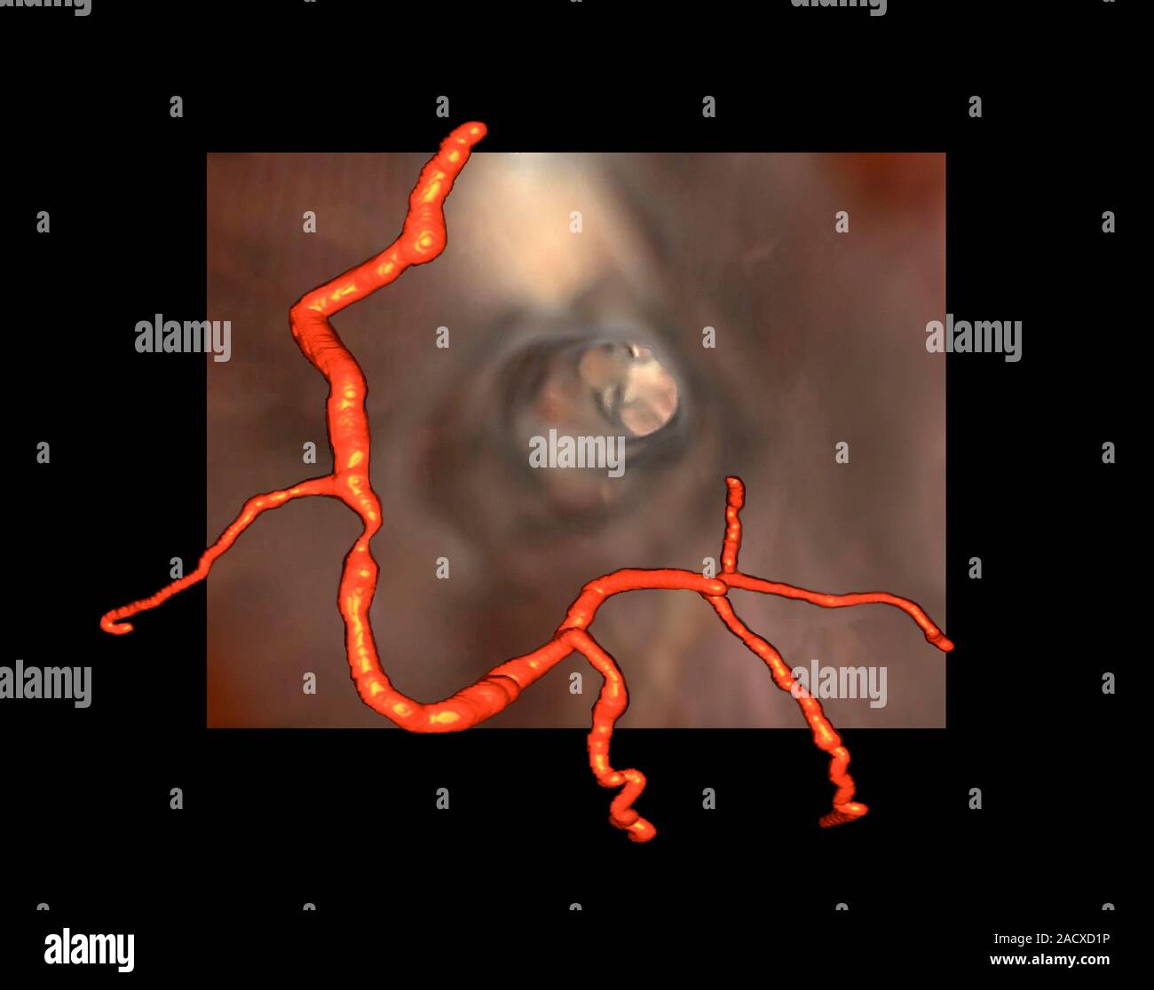 Coronary stenosis. Coloured 3D computed tomography (CT) angiogram of ...