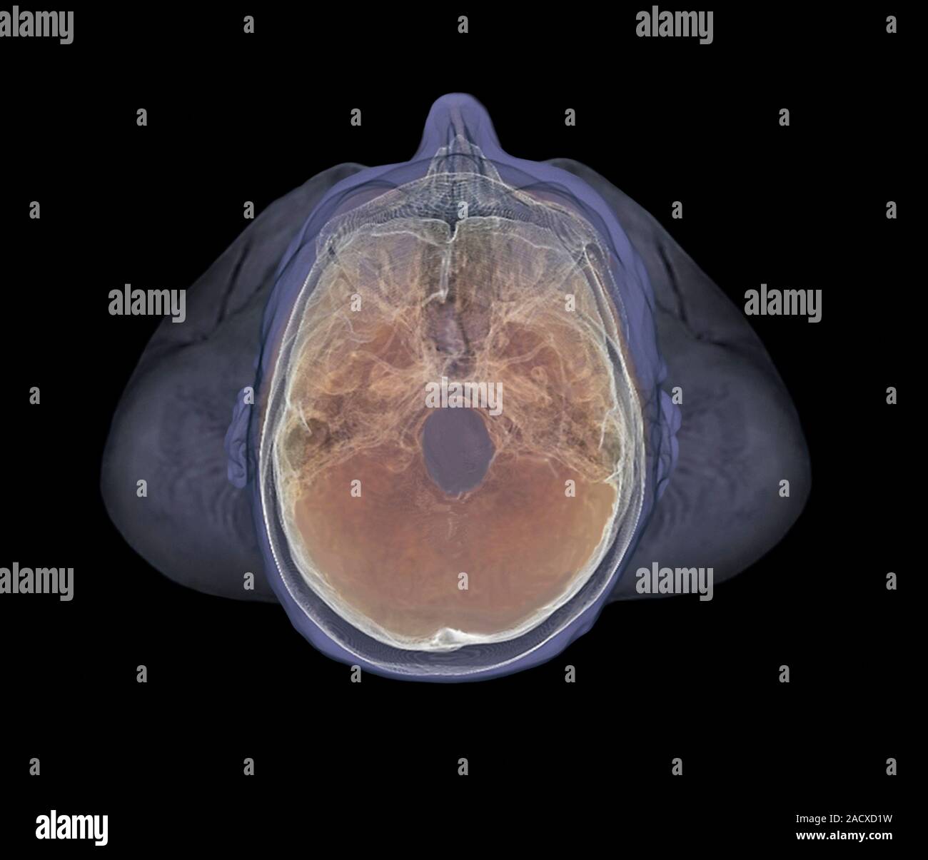 Coloured 3D computed tomography (CT) scan of a healthy adult man's head ...