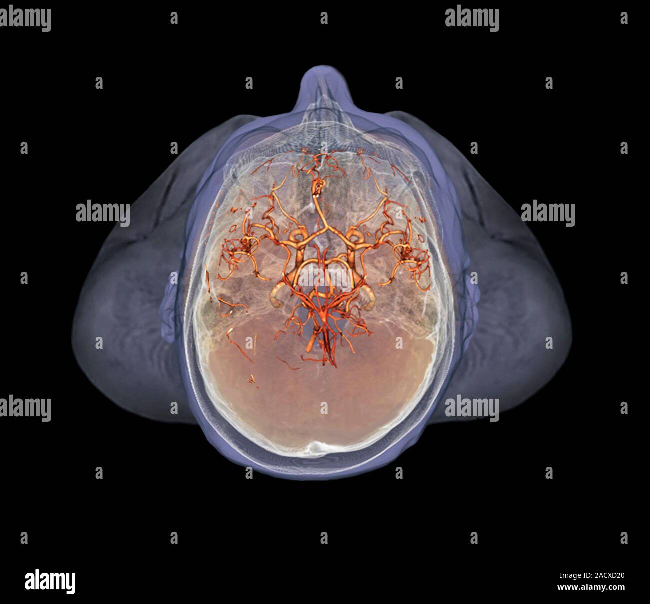 Coloured 3D computed tomography (CT) scan of a healthy adult man's head ...